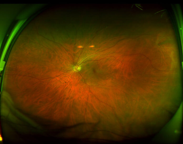 Retinal Screening Testing - Visual Eyes Group