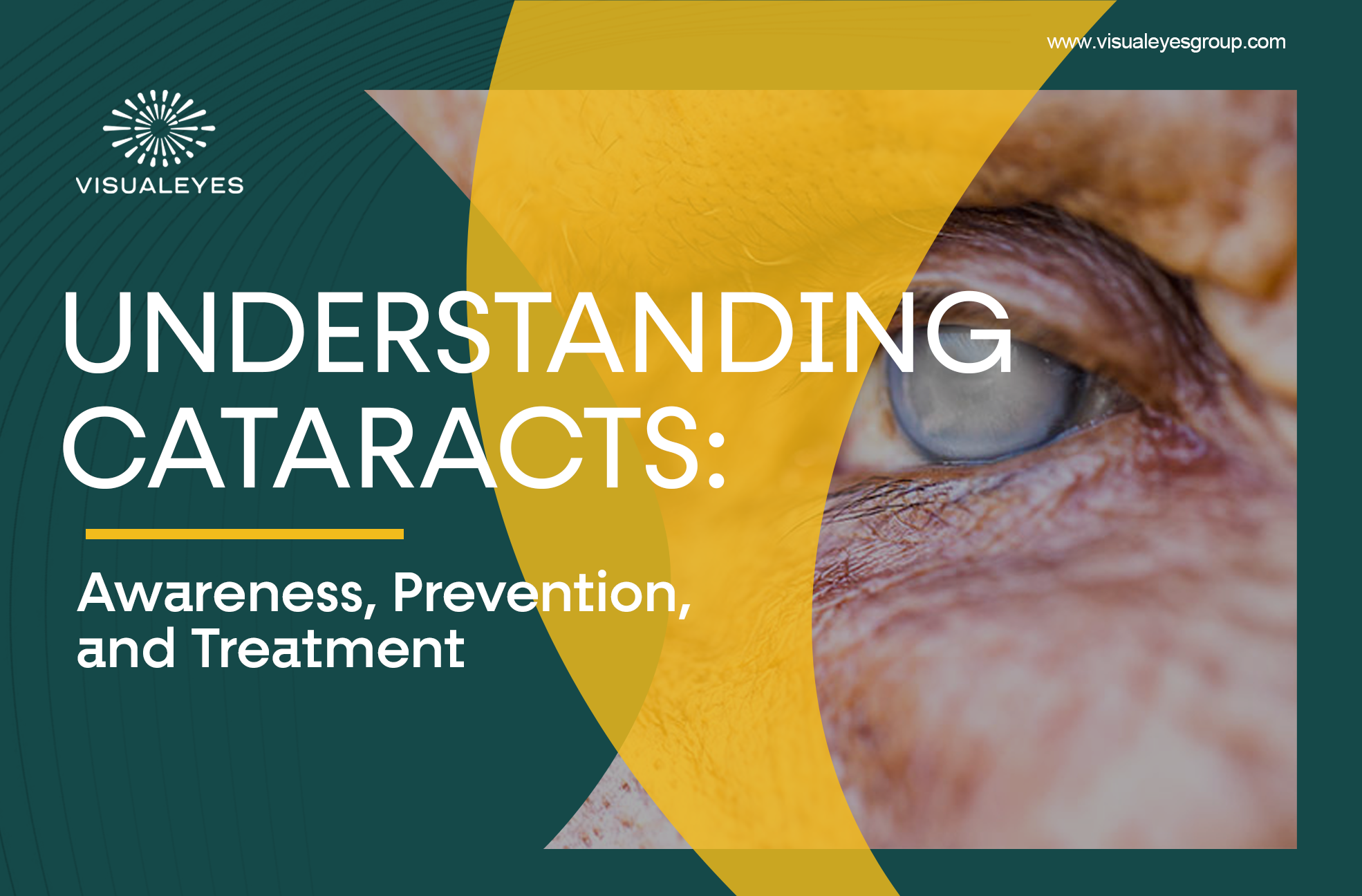 Understanding Cataracts: Awareness, Prevention, and Treatment - Visual ...